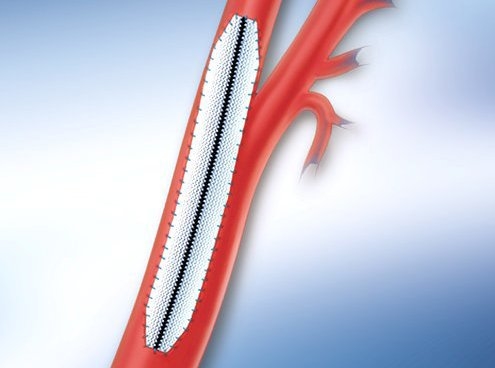 VASCULAR GRAFTS AND PATCHES-vascular Archives - AVOMA GROUP